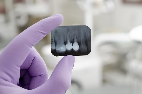 Important Facts About Dental X-Rays - All Smiles Dental Center San ... Important Facts About Dental X-Rays - All Smiles Dental Center San ...
